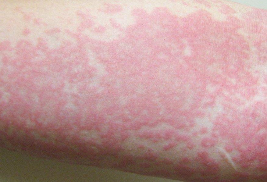 Urticaria - Dr. John KC